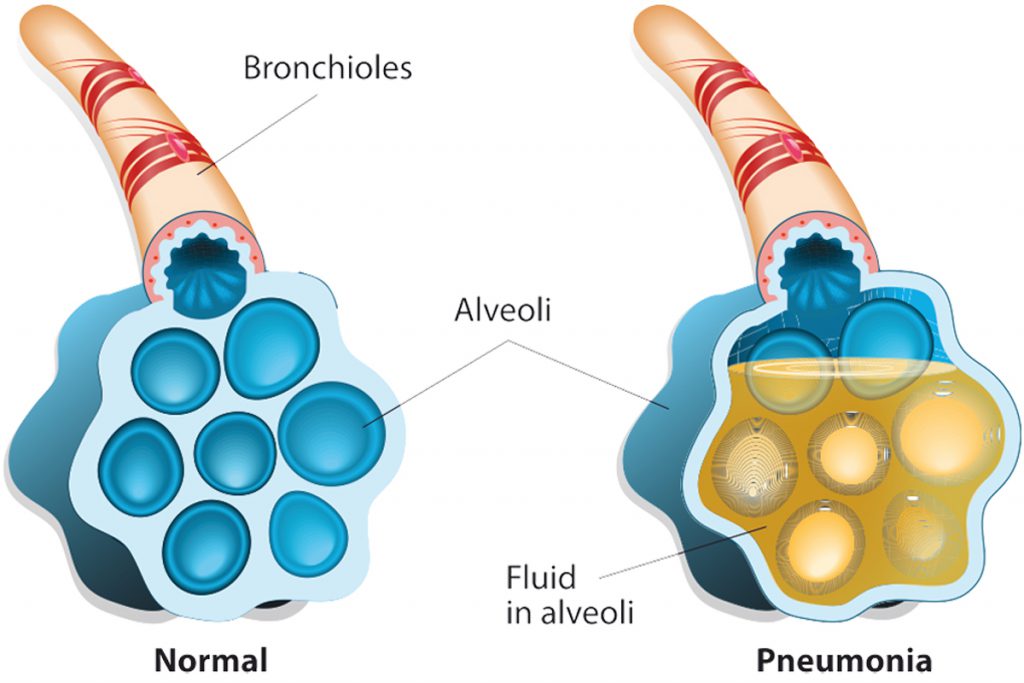 Pneumonia – Saans Foundation